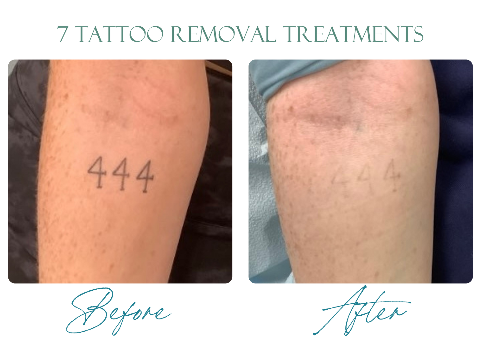 Laser Services in Oxford, MS – DAO